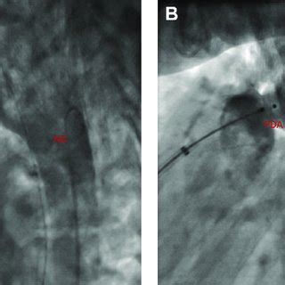 A Pda Visualized On Cardiac Catheterization B Pda With Amplatzer
