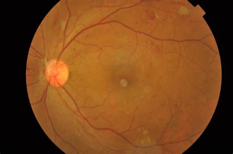 glaucoma detection classification dataset and pre trained model by testone