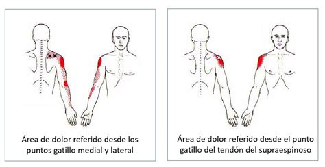 Infiltración Del Músculo Supraespinoso Dolopedia