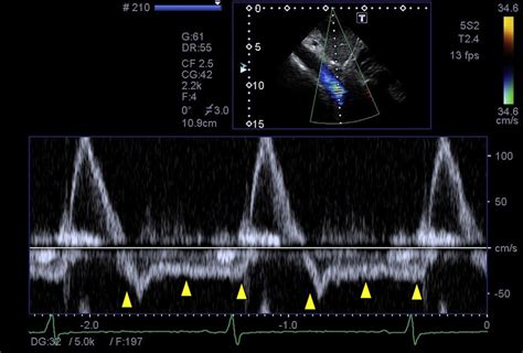Pulsed Wave Doppler Image Of The Abdominal Aorta Showing Obvious My Xxx Hot Girl