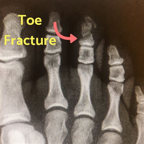 Broken Toe X Ray