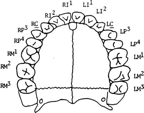 Figure 11 From Maxillary Caninethird Premolar Transposition In A