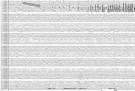 Recording From Bilateral Temporal Subdural Electrodes Showing Ictal
