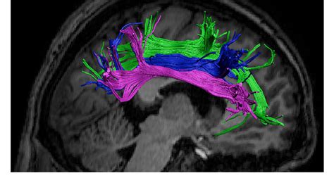 Representation Of The Left Superior Longitudinal Fasciculus Slf