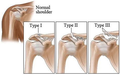 What Is Ac Joint Separation Do I Need Surgery For This