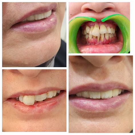 Digital Smile Transformation What A Lovely Outcome Mohammed Hamed Khan