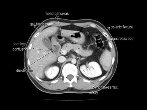 Ct Scan Images Labeled At Michelle Bishop Blog