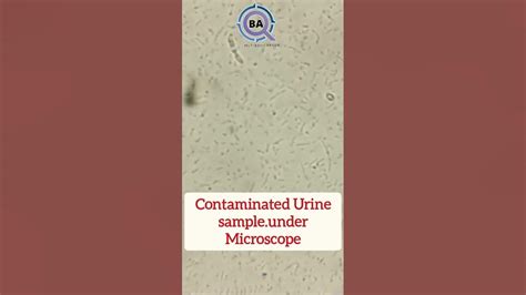 Contaminated Urine Sample Under Microscope Youtube
