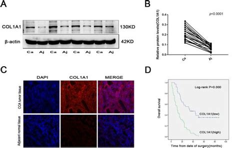 Cholangiocarcinoma Metastasis Liverdisease Annals Of Hepatology