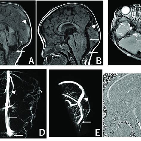 Pdf Two Cases Of Persistent Falcine And Occipital Sinuses