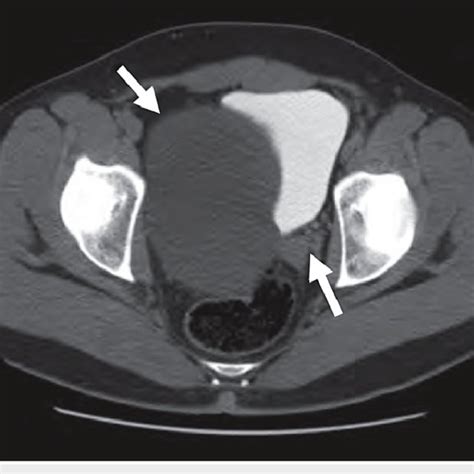 Axial Computed Tomography Image Axial Contrast Enhanced Computed