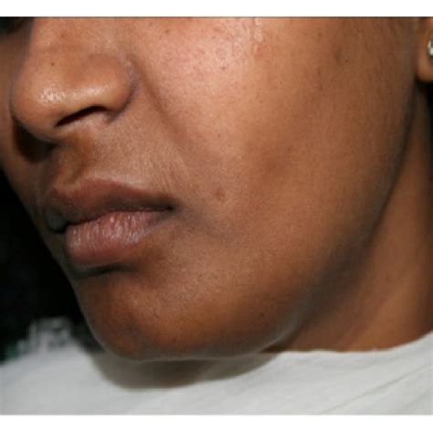 Photomicrograph Showing Diffuse Swelling On Lower Left Side Of Face