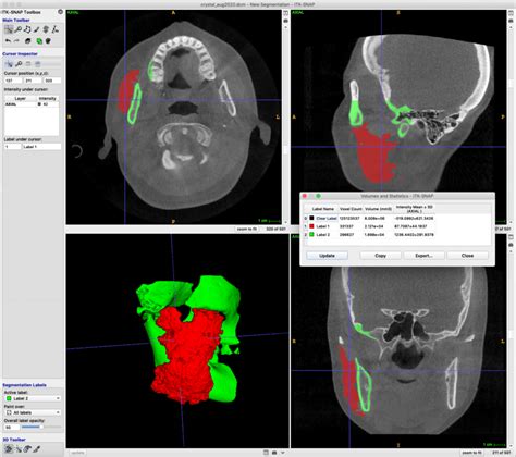 Questions With Answers In ITK SNAP Science Topic