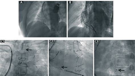 A Upgrade From A Ddd Pm Implanted Via The Left Subclavian Artery To
