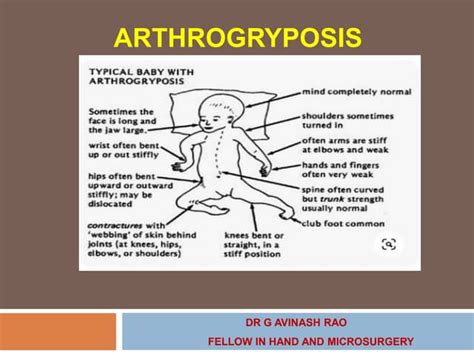Arthrogryposis Pptx