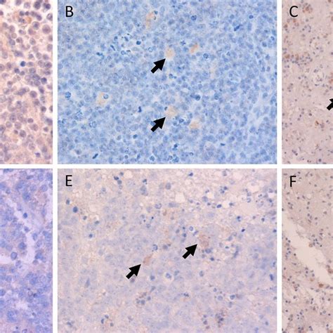 The Expression Of Siglec 15 A Positive Tumor Cells B Positive