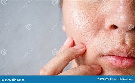 Asian Face Macro Skin With Enlarged Pores Allergic Reaction Peeling