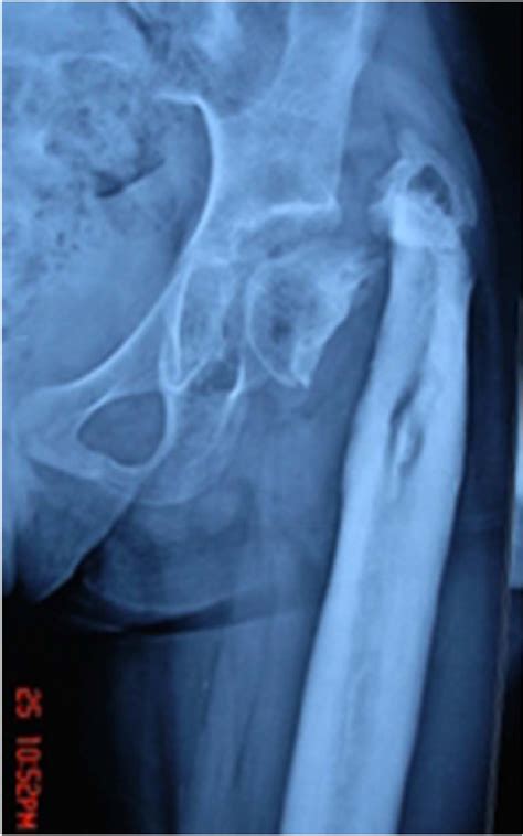 Radiograph Of Patient 6 Showing The Pseudarthrosis Site And Sequestrum Download Scientific