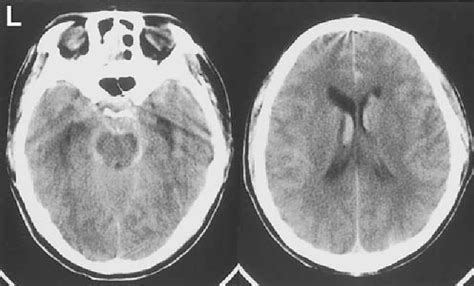 Figure 1 From Severe Subarachnoid Hemorrhage With Pulmonary Edema Successfully Treated By Intra