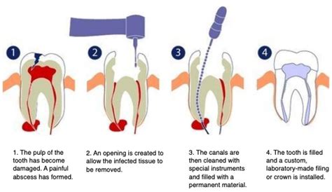 Root Canal Treatment Merivale Dental Practice