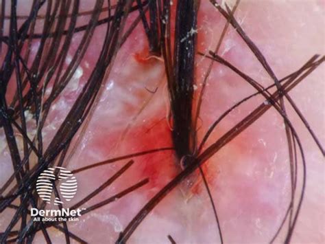 Folliculitis Decalvans Image