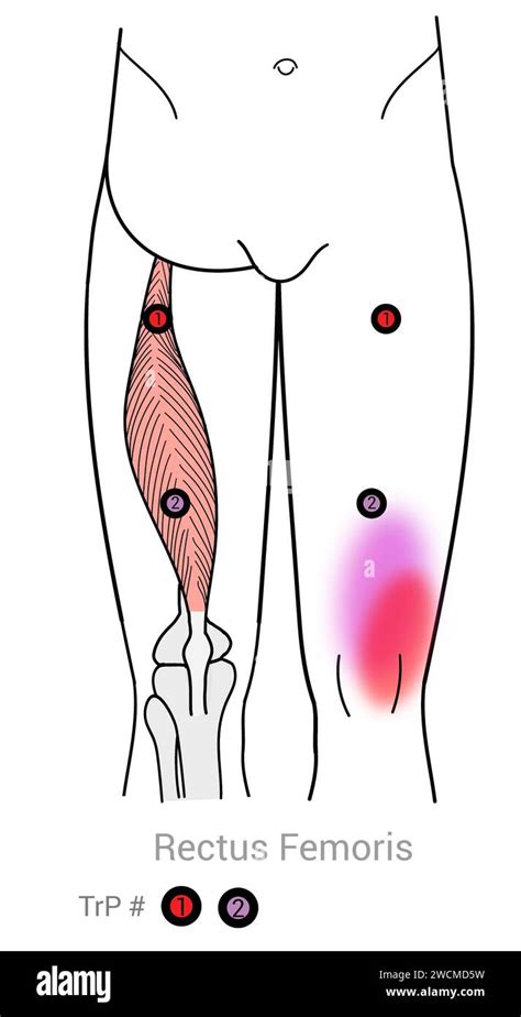 Rectus Femoris Myofascial Trigger Points And Associated Pain Locations Stock Photo Alamy