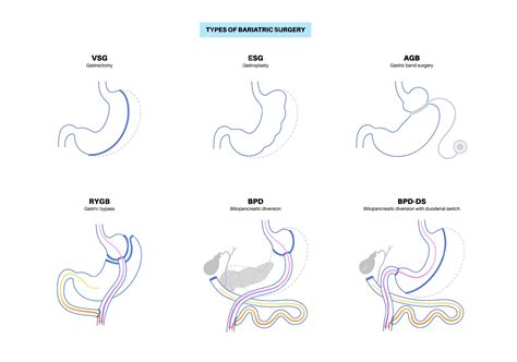 Premium Vector Types Of Bariatric Surgery Healthy Stomach And