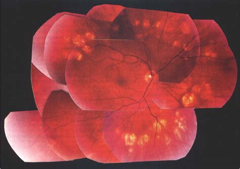 Composite Photograph Of The Right Fundus Showing Idiopathic Download Scientific Diagram