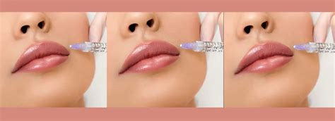 Everything You Need To Know Before Getting Lip Fillers Glow By Rabia