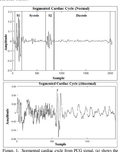 Figure 1 From Heart Sound Classification From Wavelet Decomposed Signal Using Morphological And
