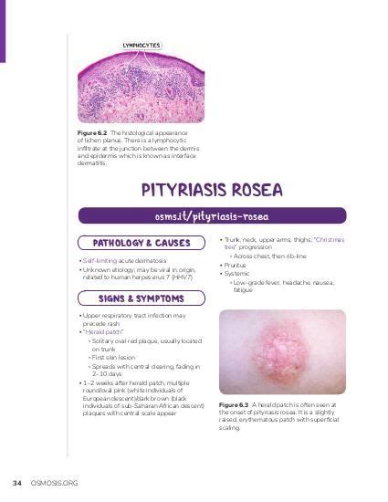 Pityriasis Rosea Video Causes And Meaning Osmosis