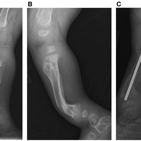 Case 1 Ap View Of Right Hand Demonstrates Delayed Carpal Ossification Download Scientific
