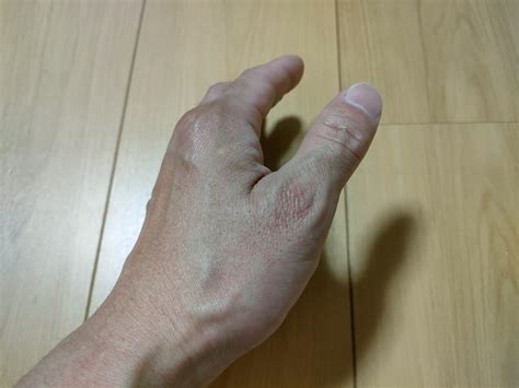 母指cm関節症の装具作りに 漁師の徒然なるブログ