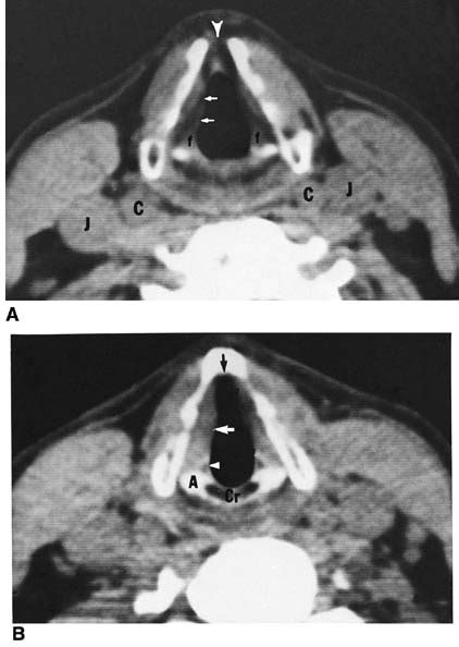 True And False Vocal Cords Model