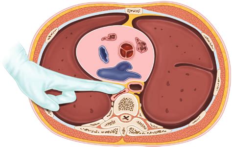 Anterolateral Thoracotomy