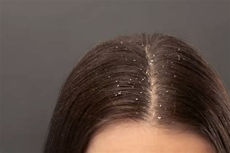 ¿cómo Eliminar La Caspa Trucos Caseros Saludables Y Fáciles De