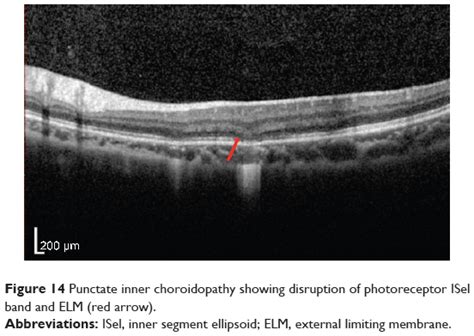 Photoreceptor Inner Segment Ellipsoid Band Integrity On Spectral Domai