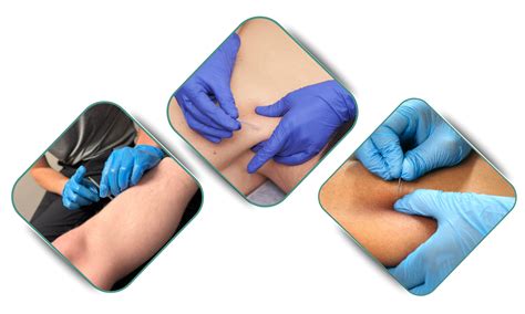 Ims Dry Needling Heal All Physiotherapy