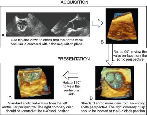 Imaging The Aortic Valve Clinical Tree