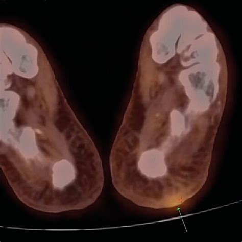 Staging Of A Cutaneous Melanoma Patient One Month After Tumor Excision Download Scientific