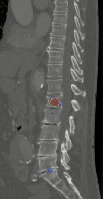 Detection Of Vertebral Fractures In Ct Using 3d Convolutional Neural Networks Deepai