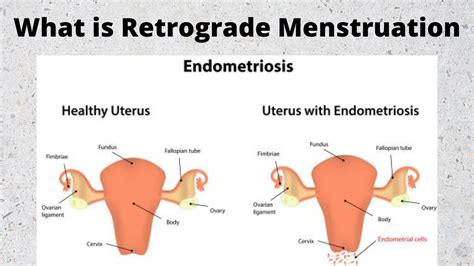 What Is Retrograde Menstruation Youtube