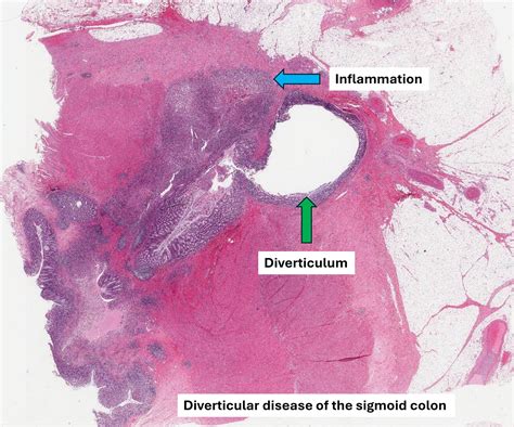 Diverticular Disease Mypathologyreport
