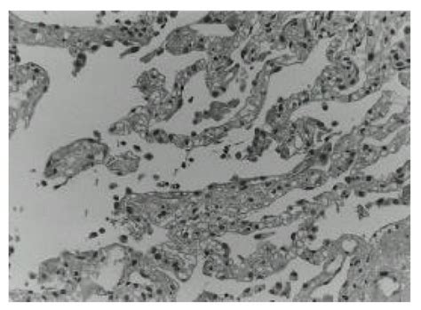 Mercury Inhalation Poisoning And Acute Lung Injury PMC