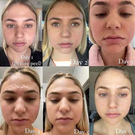 Day By Day Chemical Peel Recovery The Ultimate Guide Chemical Peel