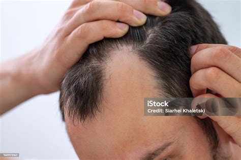 탈모로 고통받는 대머리가 있는 남자 모발 문제 치료 남자에 대한 스톡 사진 및 기타 이미지 남자 털 문제 Istock