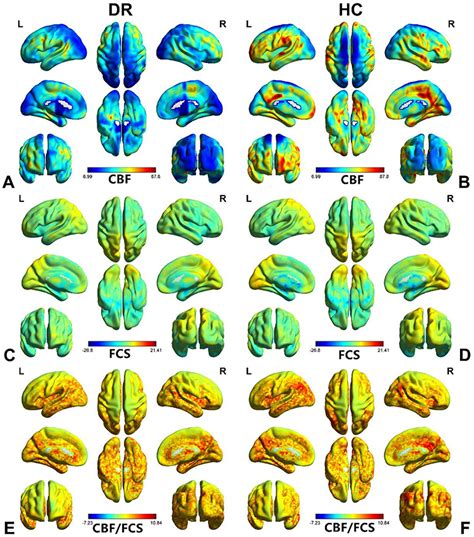 Aberrant Neurovascular Coupling In Dr Using Asl And Fmri Dmso