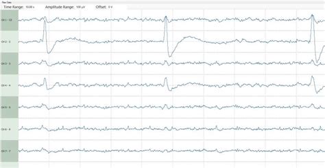 Vanessa M On Linkedin Eeg Brainwaves