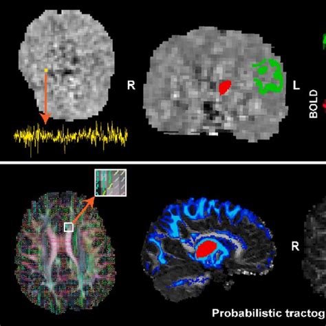 Thalamocortical Functional And Structural Connectivity Processing