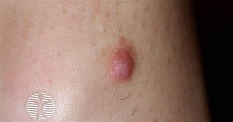 Dermatofibroma Image